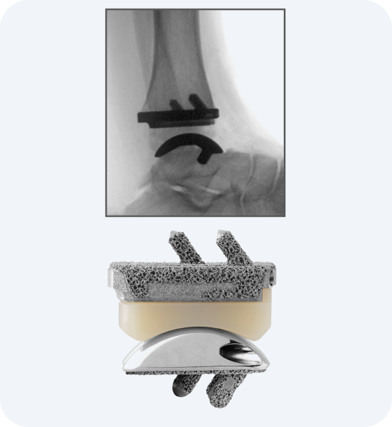 Foot & Ankle Reconstruction - Thrive Reconstructive Surgery