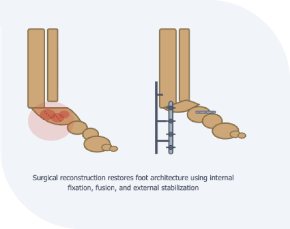 Foot & Ankle Reconstruction - Thrive Reconstructive Surgery
