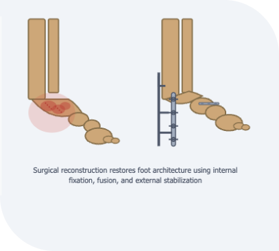 Foot & Ankle Reconstruction - Thrive Reconstructive Surgery